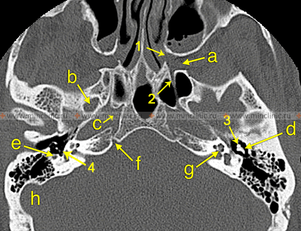 MIN — Head CT Scan (Brain & Skull Base): Diagnosis & Imaging.