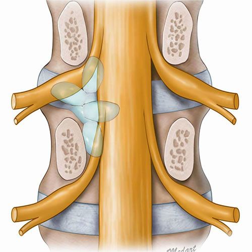MIN — Herniated & Bulging Intervertebral Discs: Types, Symptoms ...